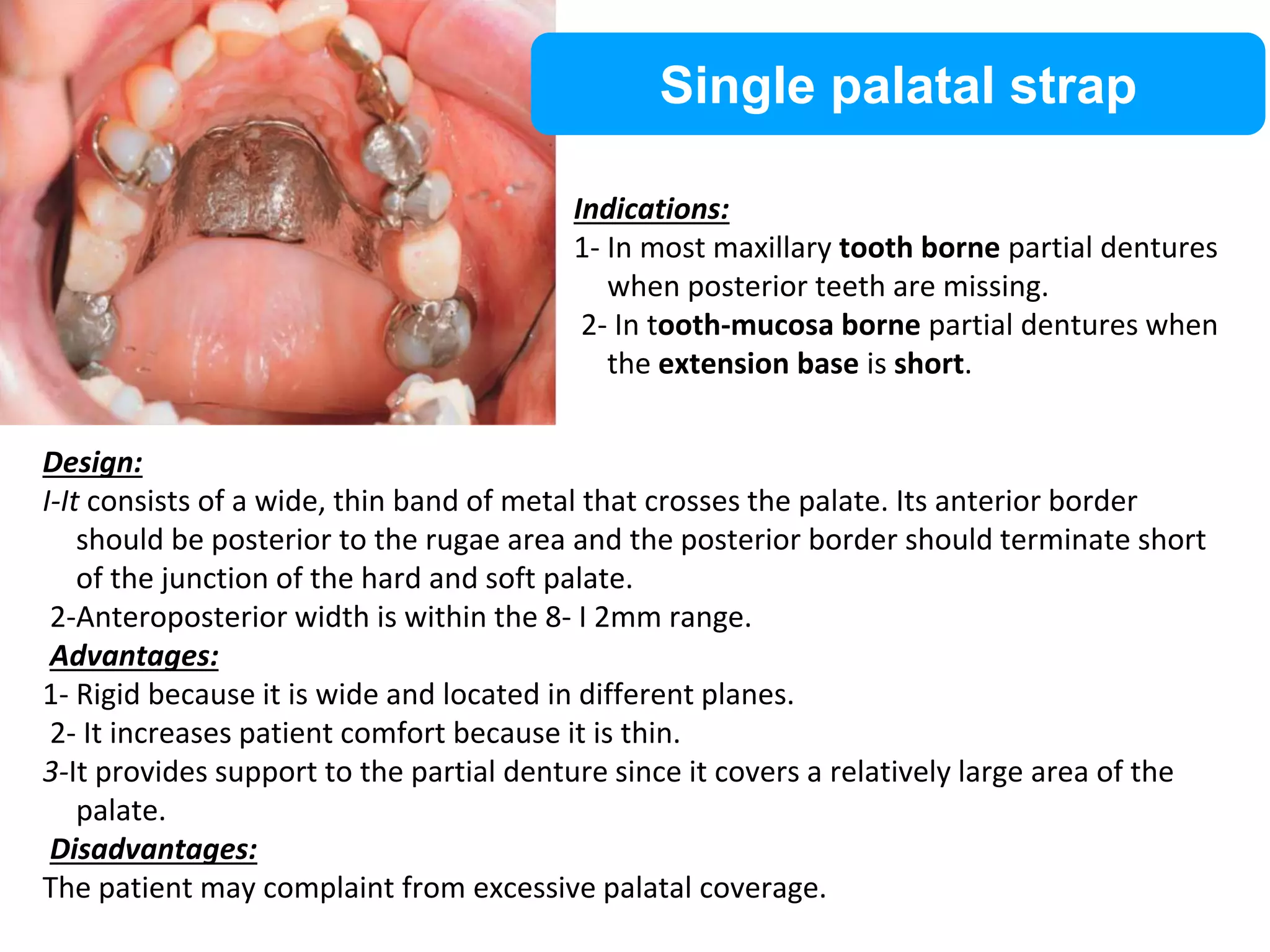 PPT (FINAL)The principles of RPD design & its components (Year 3) .pptx