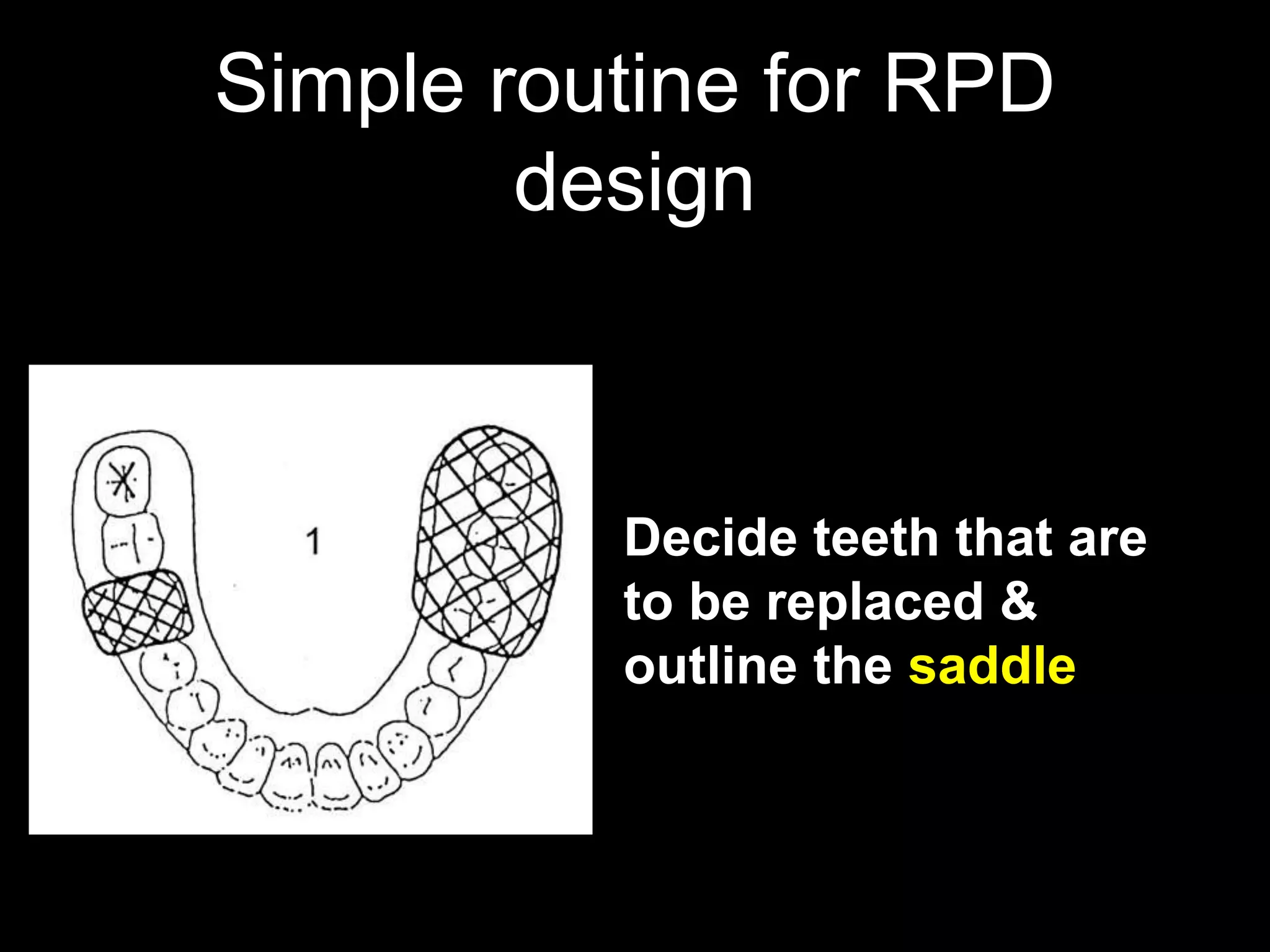PPT (FINAL)The principles of RPD design & its components (Year 3) .pptx ...
