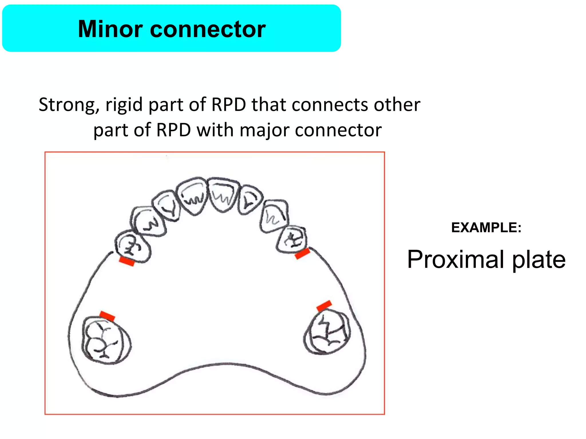 PPT (FINAL)The principles of RPD design & its components (Year 3) .pptx