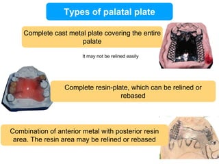 PPT (FINAL)The principles of RPD design & its components (Year 3) .pptx
