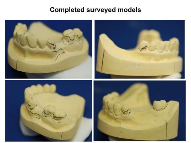 PPT (FINAL)The principles of RPD design & its components (Year 3) .pptx ...
