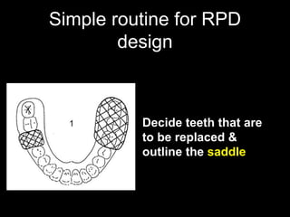 PPT (FINAL)The principles of RPD design & its components (Year 3) .pptx