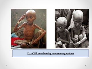 food science nutritional disorder | PPT