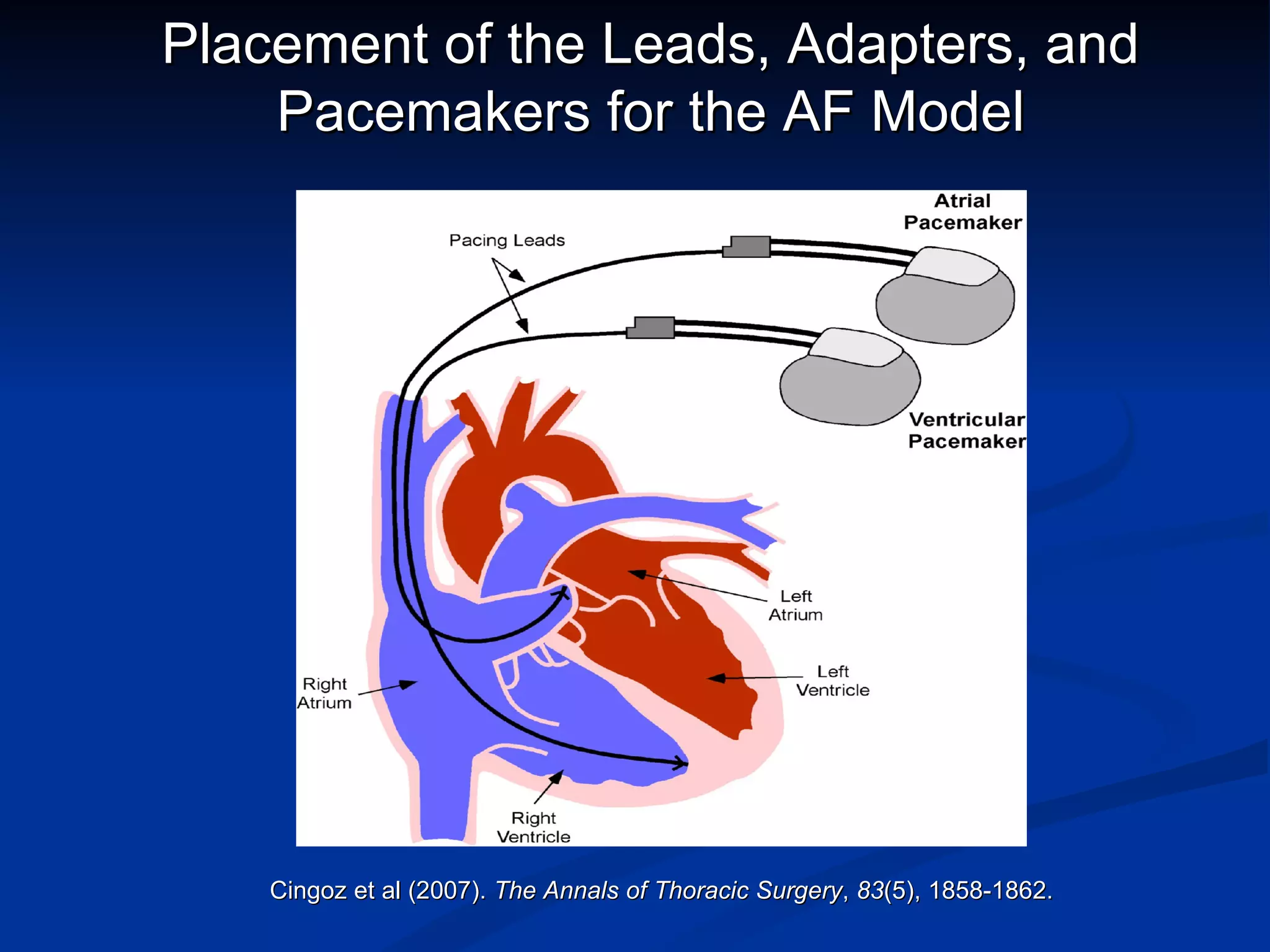 Cardiac Pacing for Heart Failure Patients | PPT