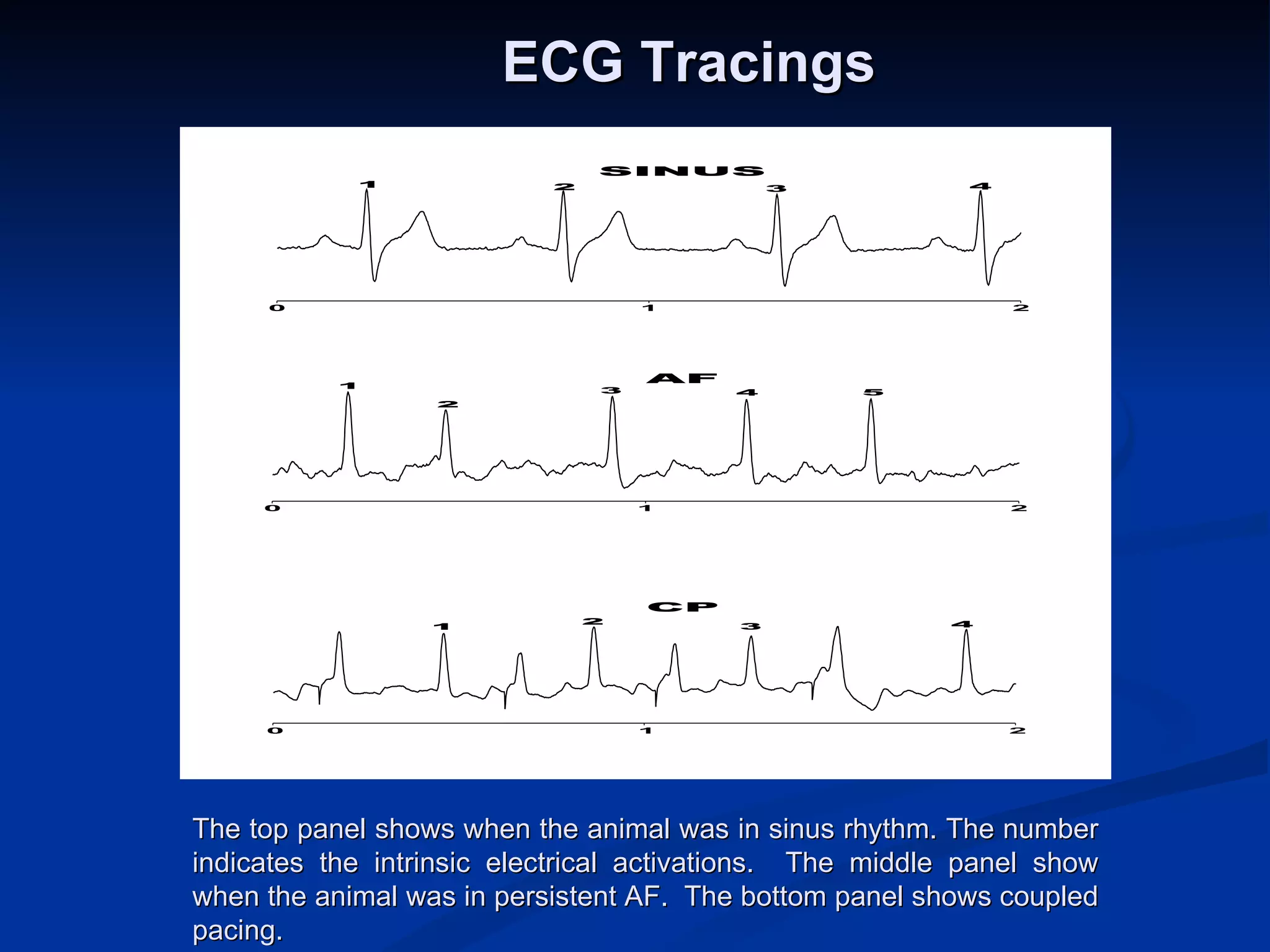 Cardiac Pacing for Heart Failure Patients | PPT