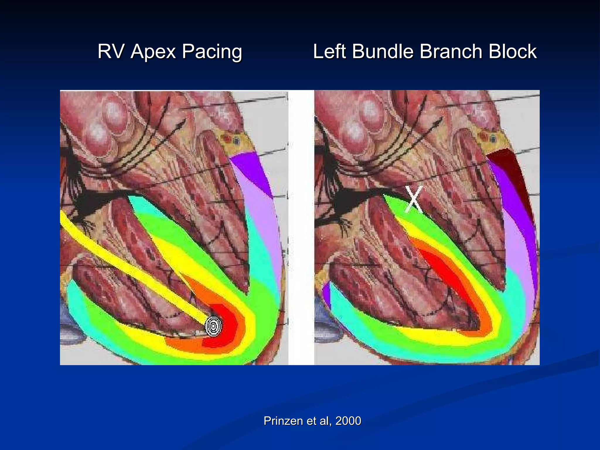 Cardiac Pacing for Heart Failure Patients | PPT