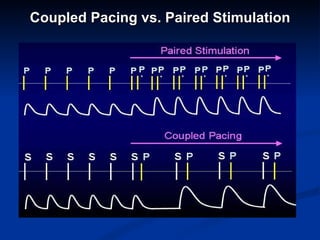 Cardiac Pacing for Heart Failure Patients | PPT