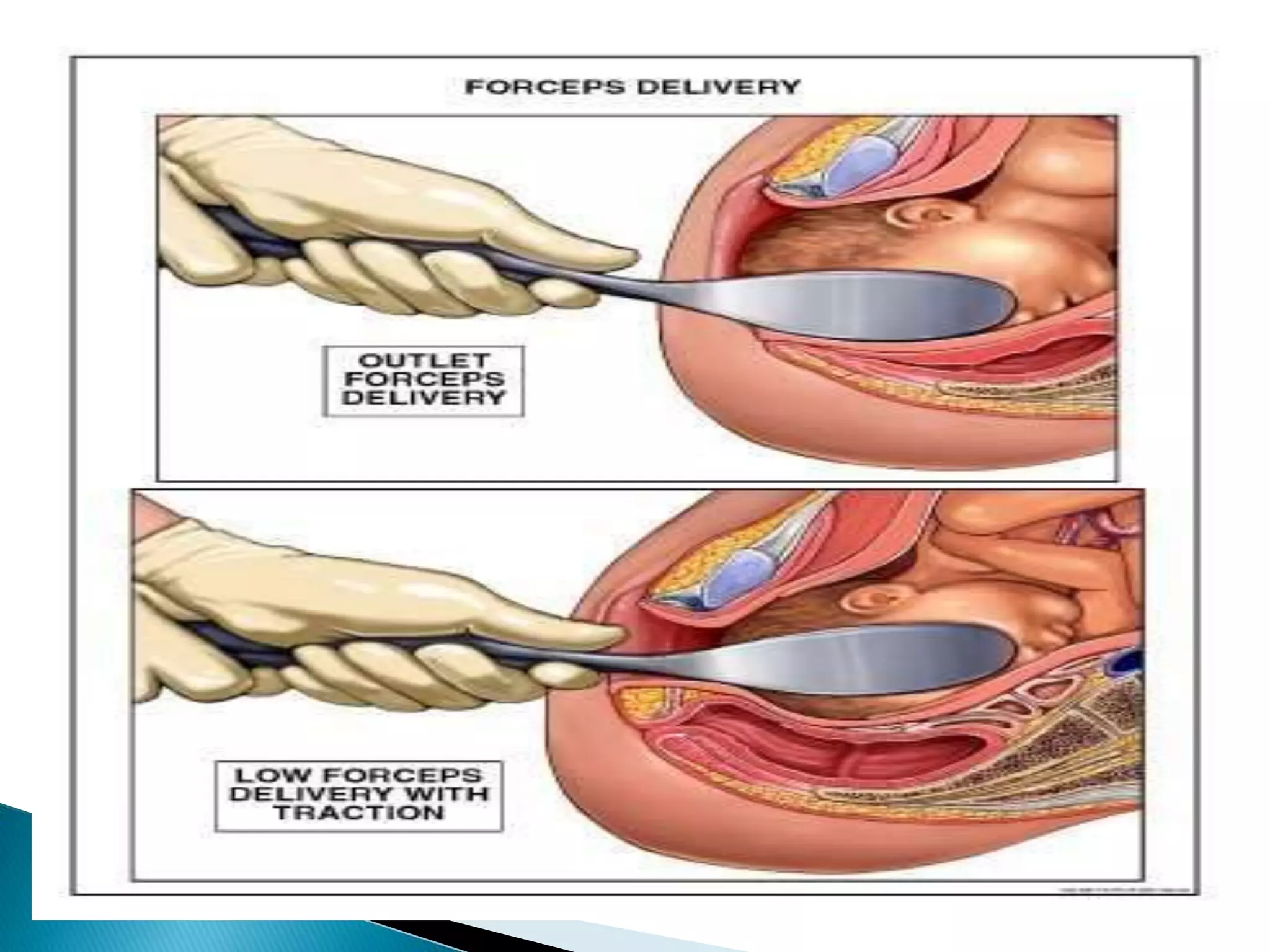 forceps delivery | PPTX