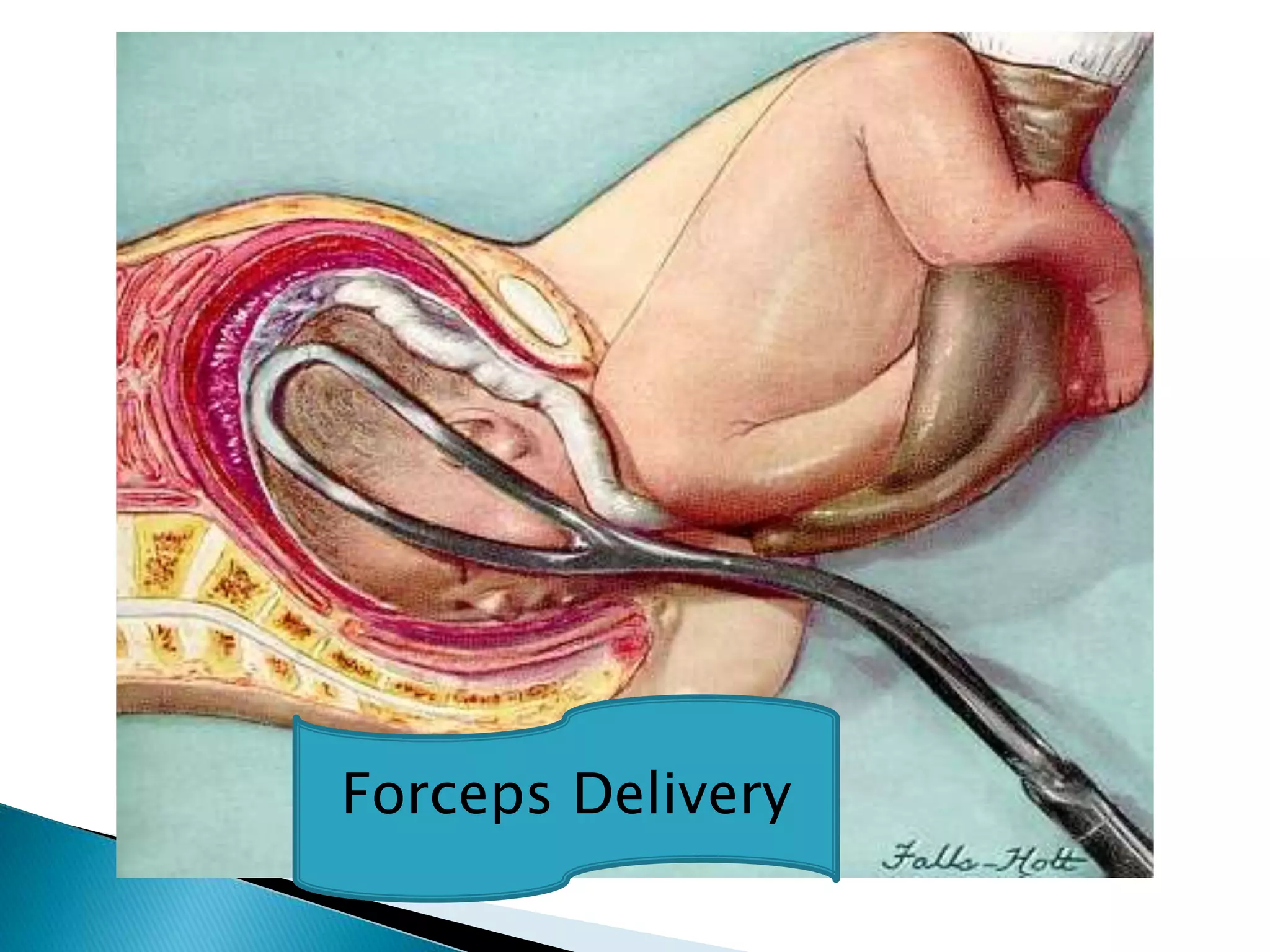 forceps delivery | PPTX