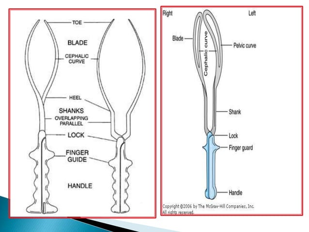 forceps delivery | PPTX | Pregnancy | Reproductive Health
