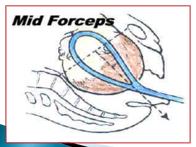 forceps delivery | PPT