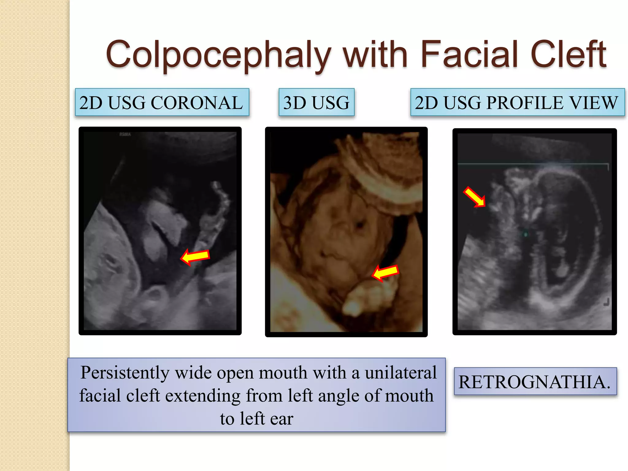 mri vs usg for fetal cns anoalies | PPTX