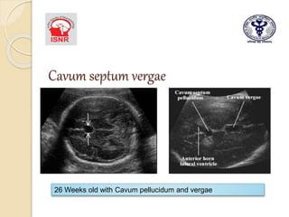Mri Vs Usg For Fetal Cns Anoalies Pptx