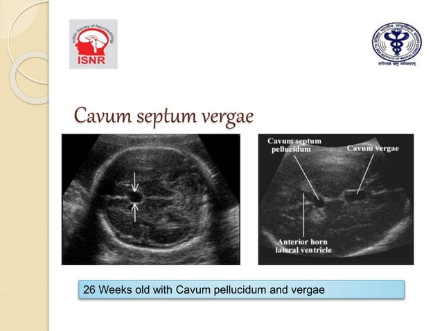 mri vs usg for fetal cns anoalies | PPT