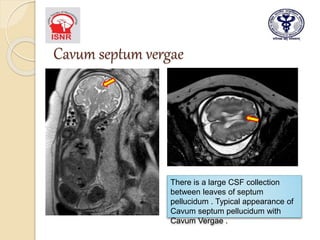 mri vs usg for fetal cns anoalies | PPT