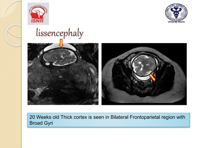 mri vs usg for fetal cns anoalies | PPT