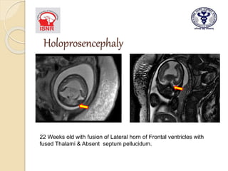 mri vs usg for fetal cns anoalies | PPT