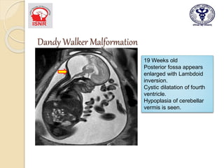 mri vs usg for fetal cns anoalies | PPT