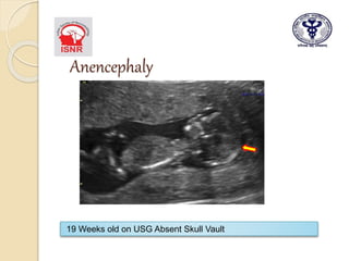 mri vs usg for fetal cns anoalies | PPT