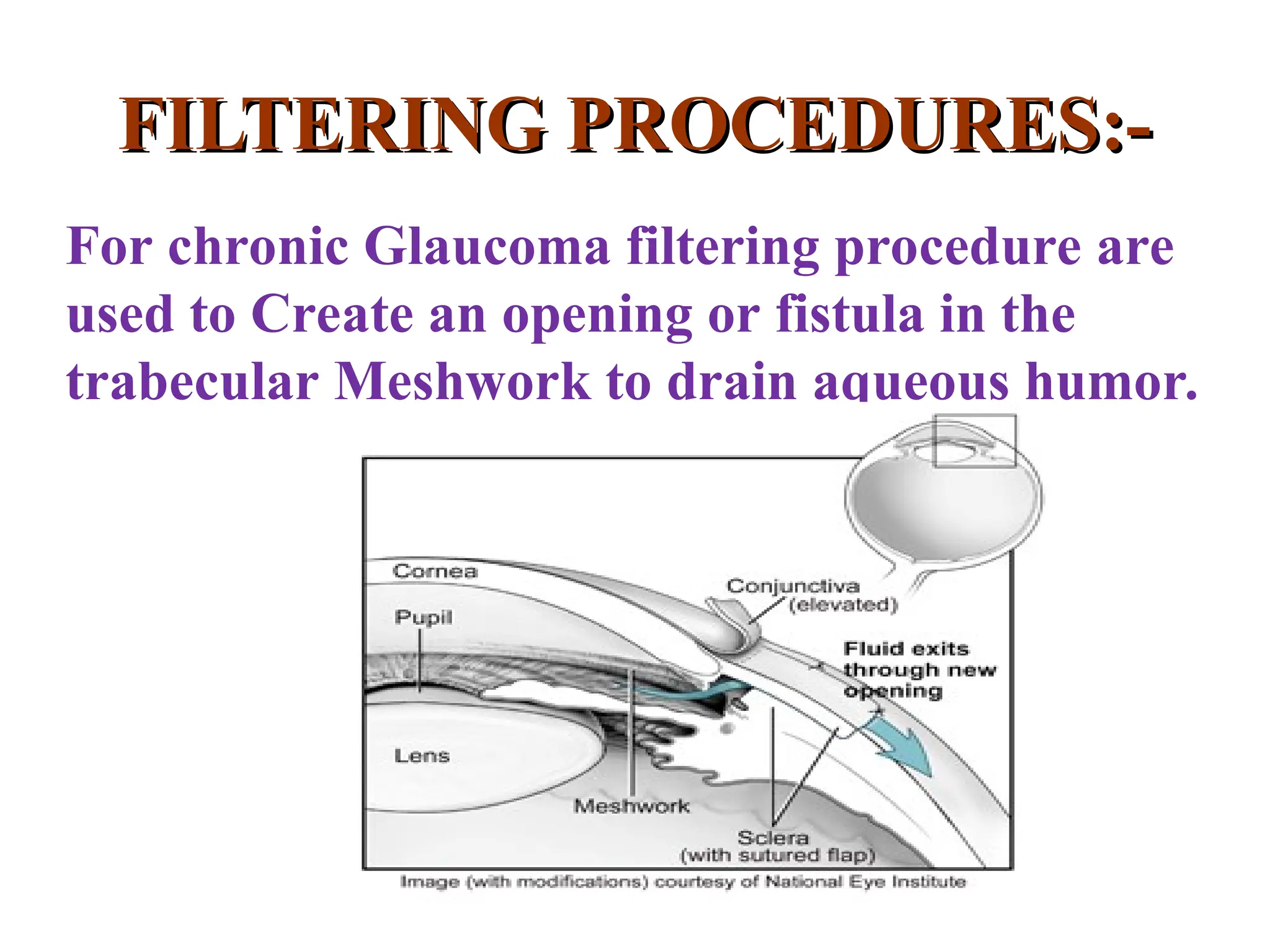 ppt for seminar glaucomma.ppt detailed explanation | PPT