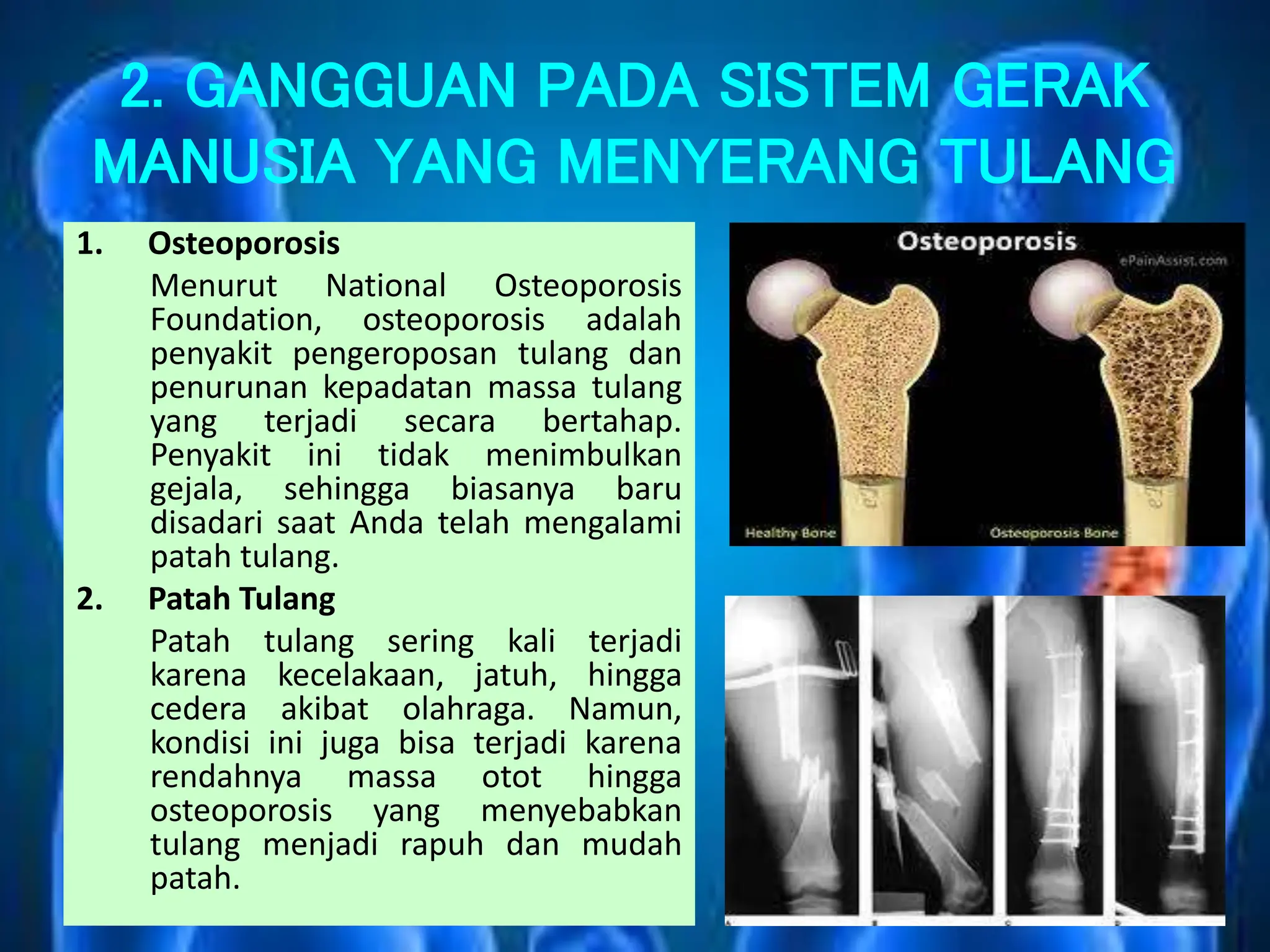 PPT GANGGUAN SISTEM GERAK PADA MANUSIA QESYA.pptx