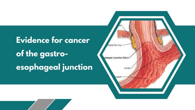PPT Gastric Cancer.pptx
