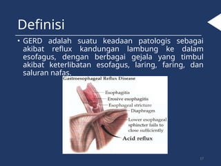 Laporan Kasus Gastroesofageal Reflux Disease | PPTX