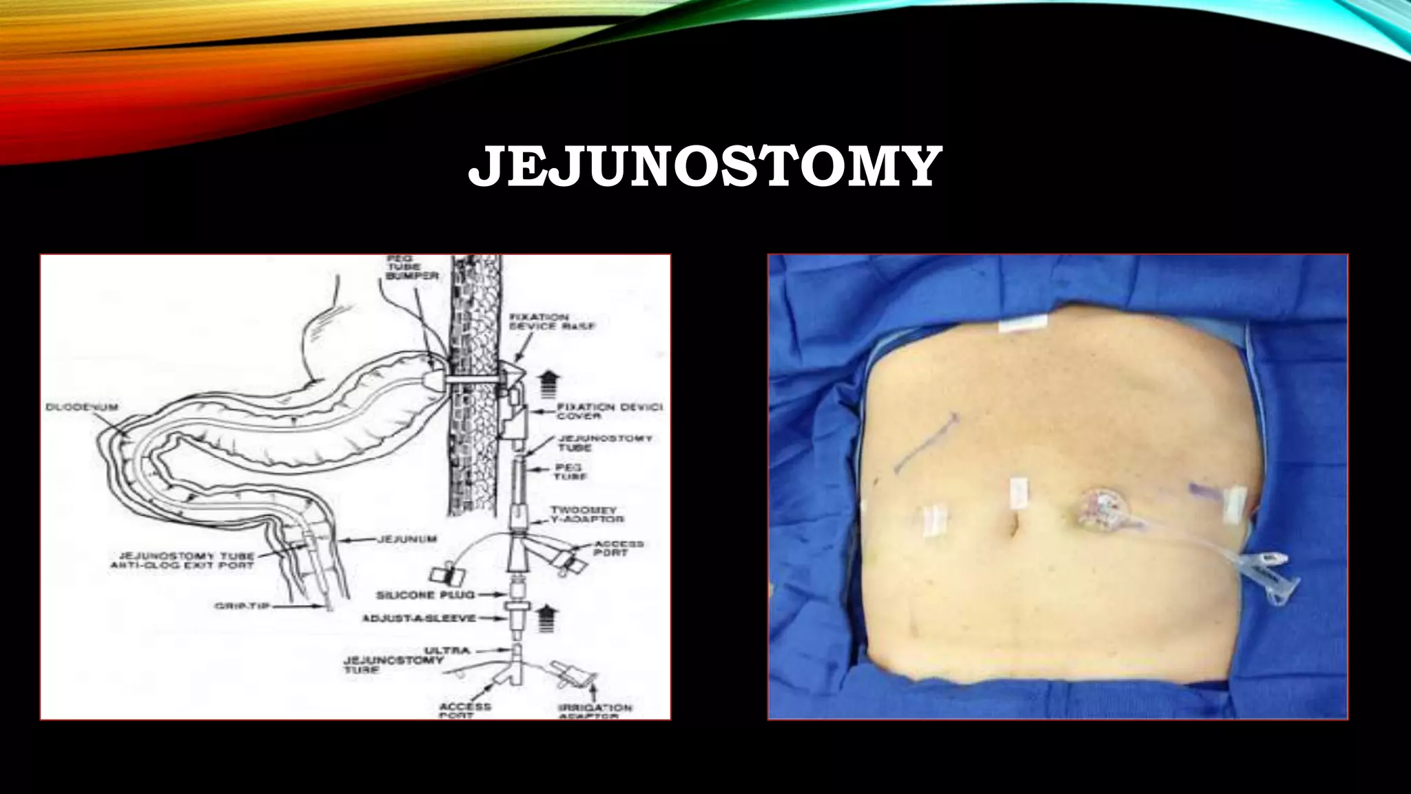 presentation on gastrostomy and jejunostomy feeding | PPTX