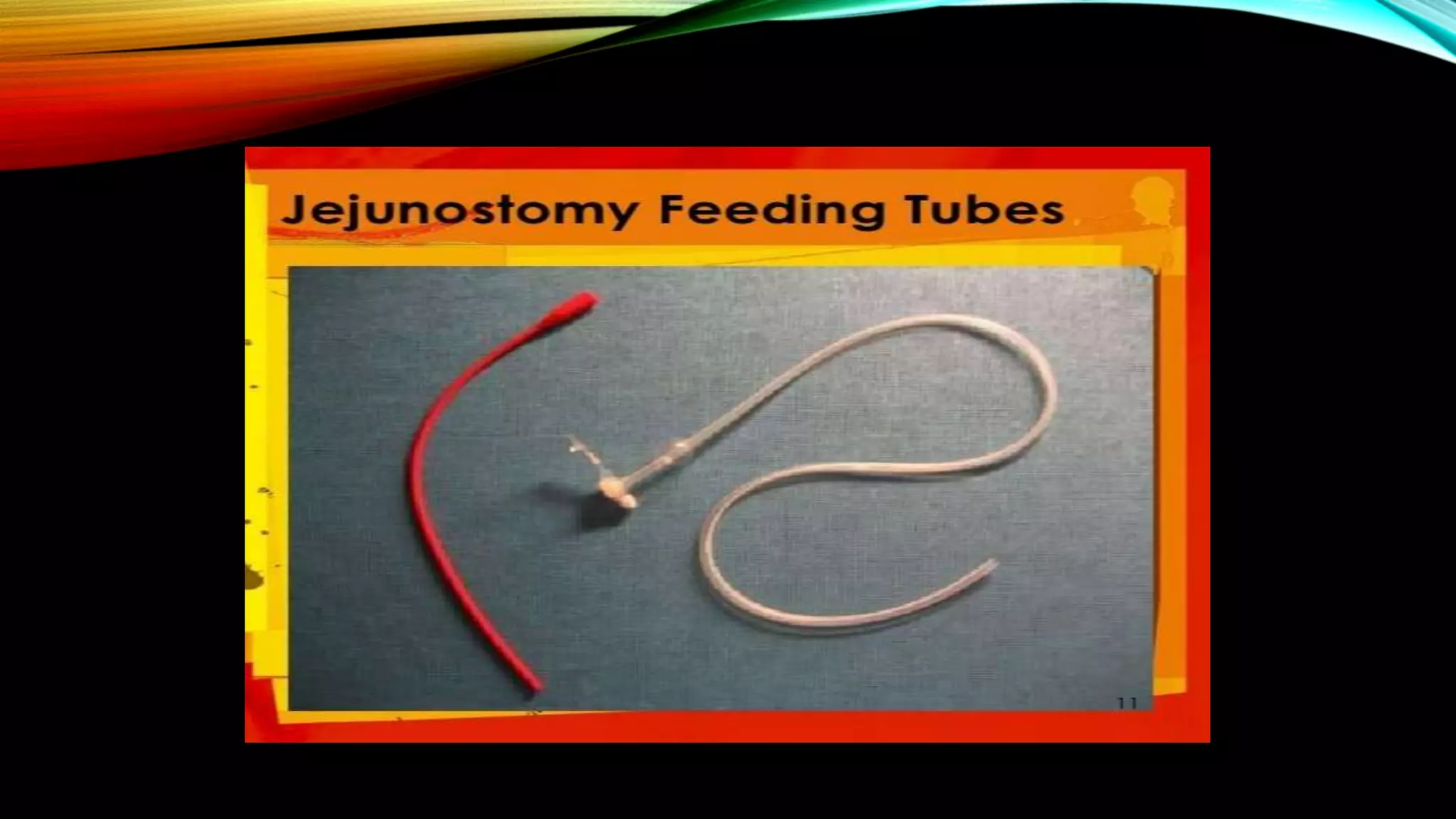 Presentation On Gastrostomy And Jejunostomy Feeding Ppt