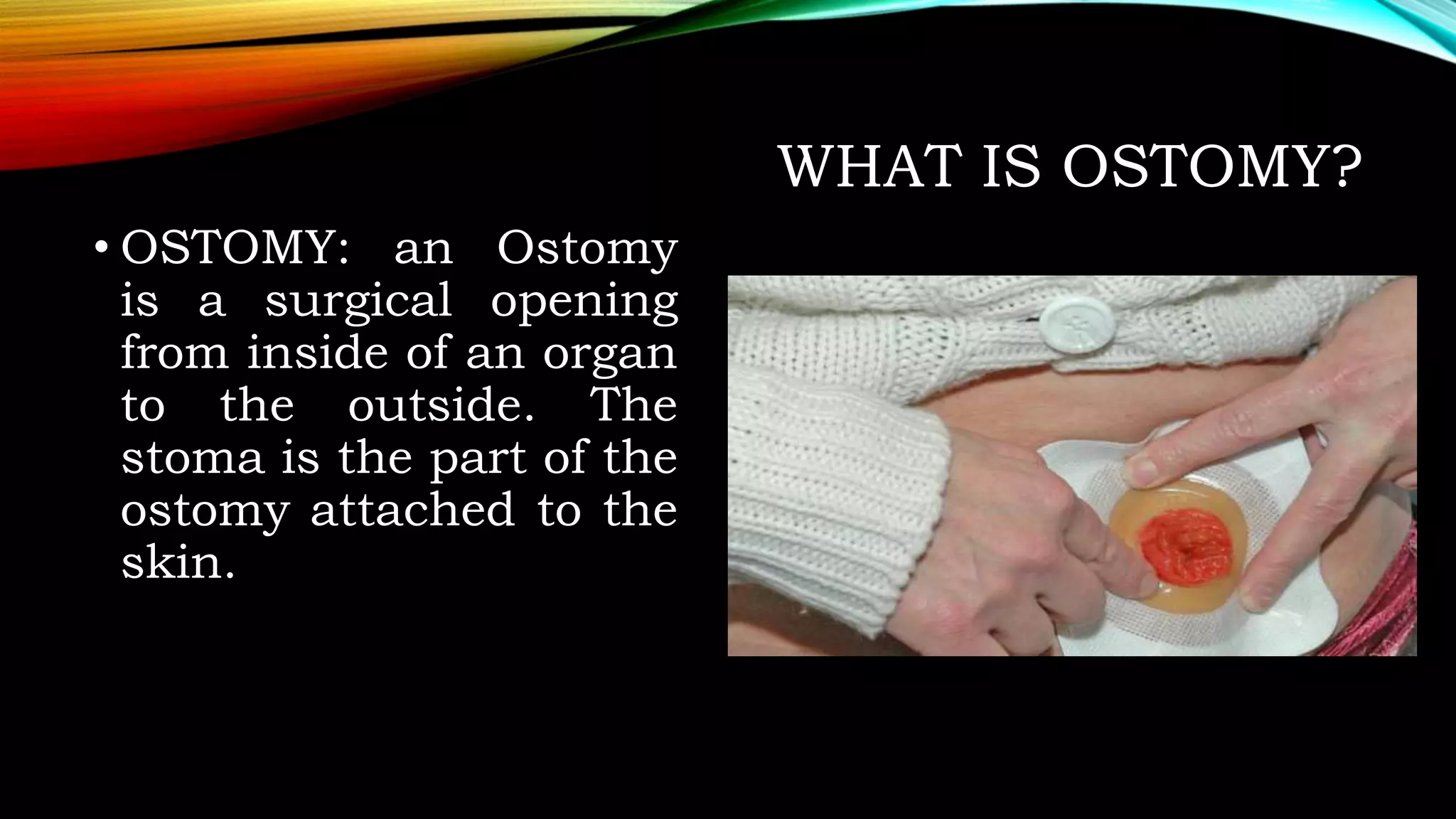 presentation on gastrostomy and jejunostomy feeding | PPTX