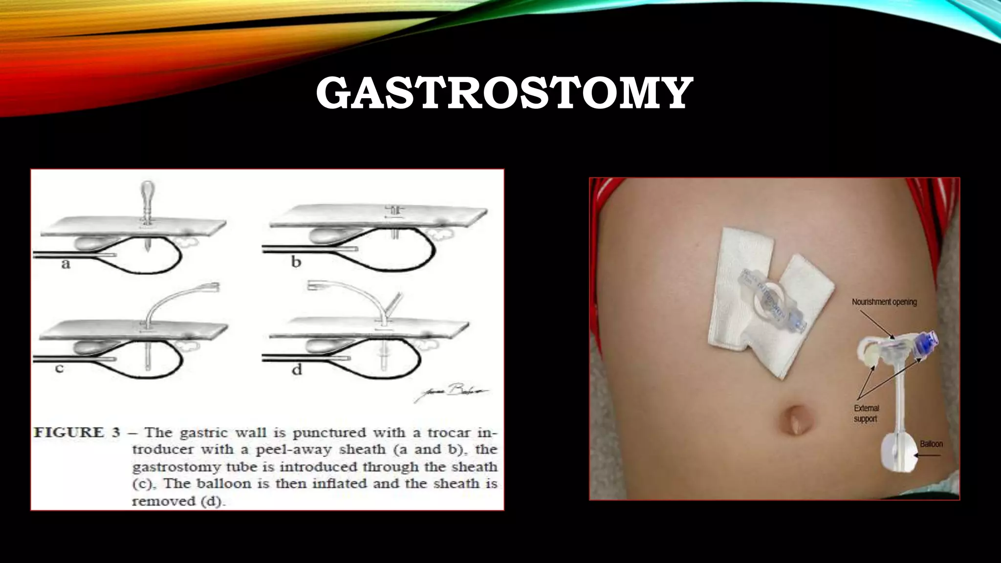 presentation on gastrostomy and jejunostomy feeding | PPTX