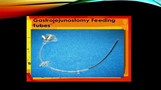 presentation on gastrostomy and jejunostomy feeding | PPTX