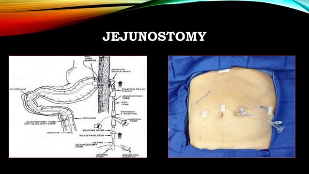 presentation on gastrostomy and jejunostomy feeding | PPTX
