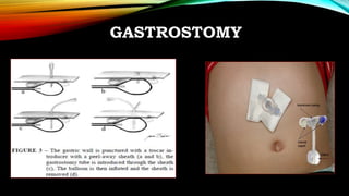 presentation on gastrostomy and jejunostomy feeding | PPT presentation on gastrostomy and jejunostomy feeding | PPT