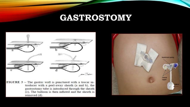 presentation on gastrostomy and jejunostomy feeding | PPT