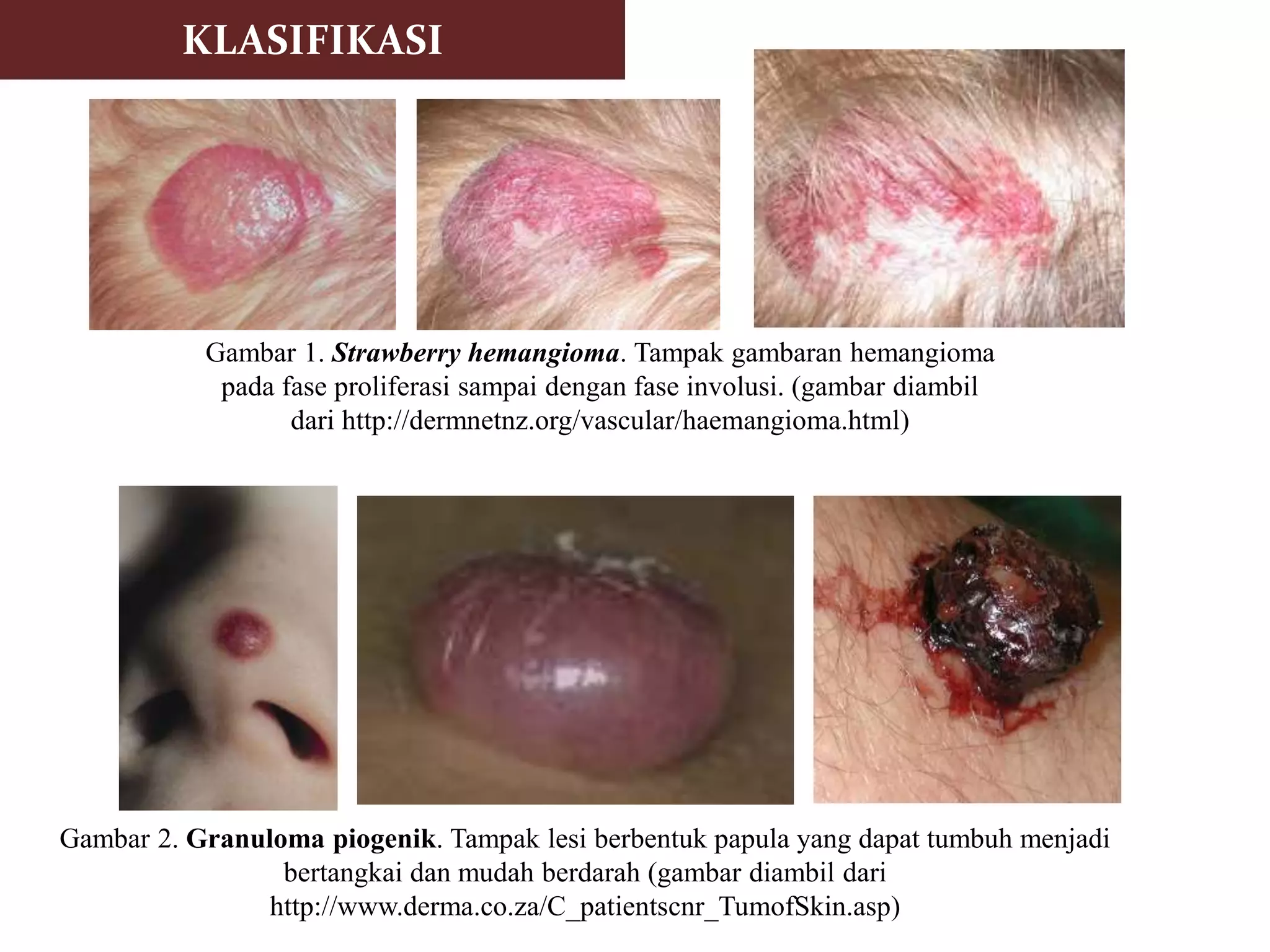 ppt hemangioma.pptx
