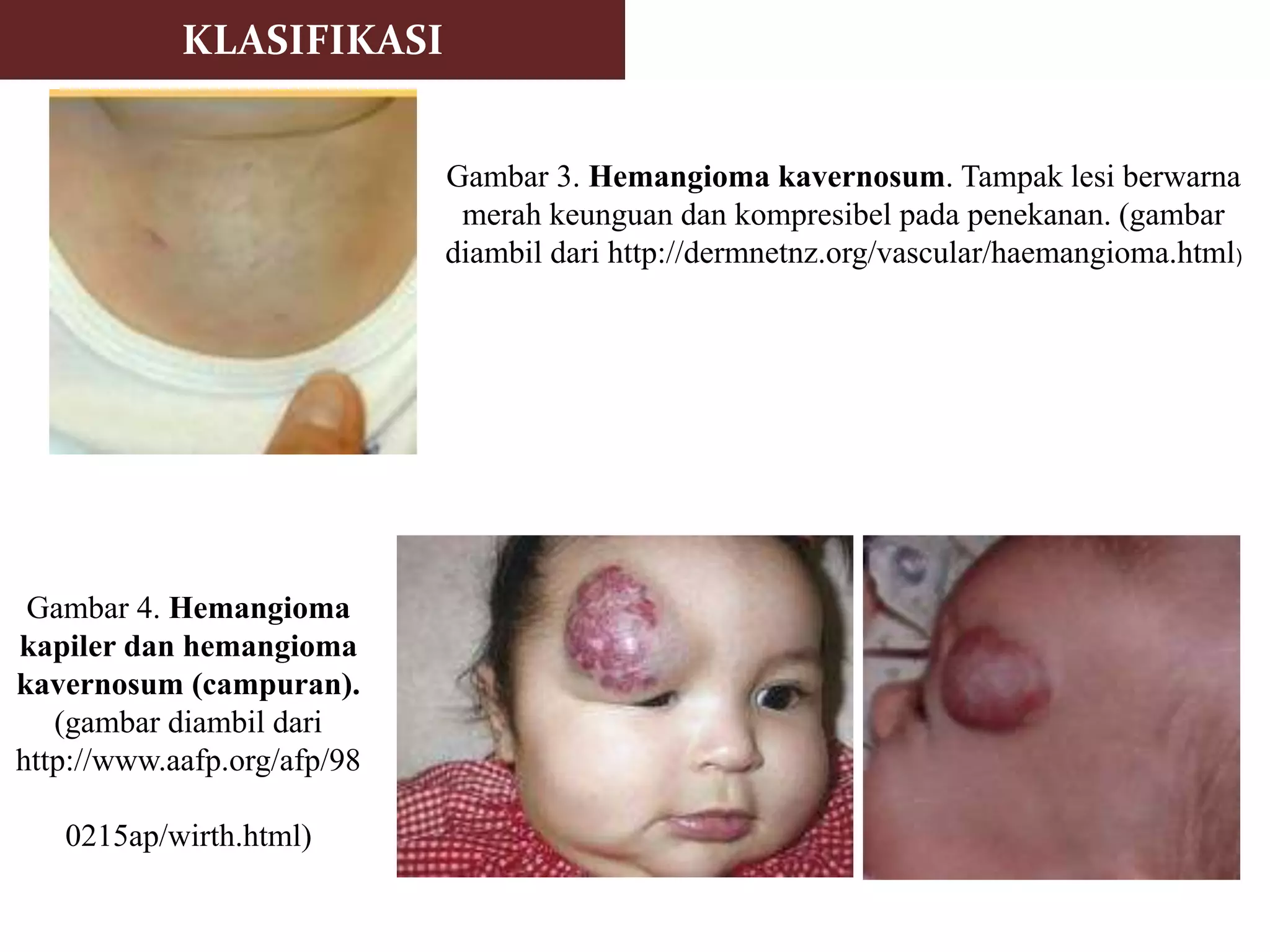 ppt hemangioma.pptx