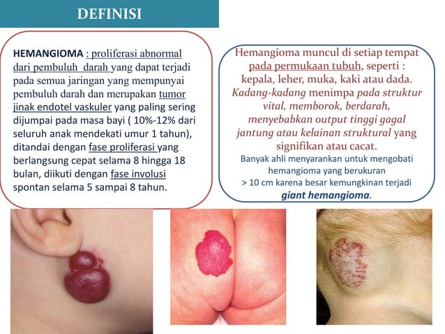 ppt hemangioma.pptx