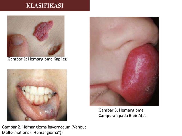 ppt hemangioma.pptx