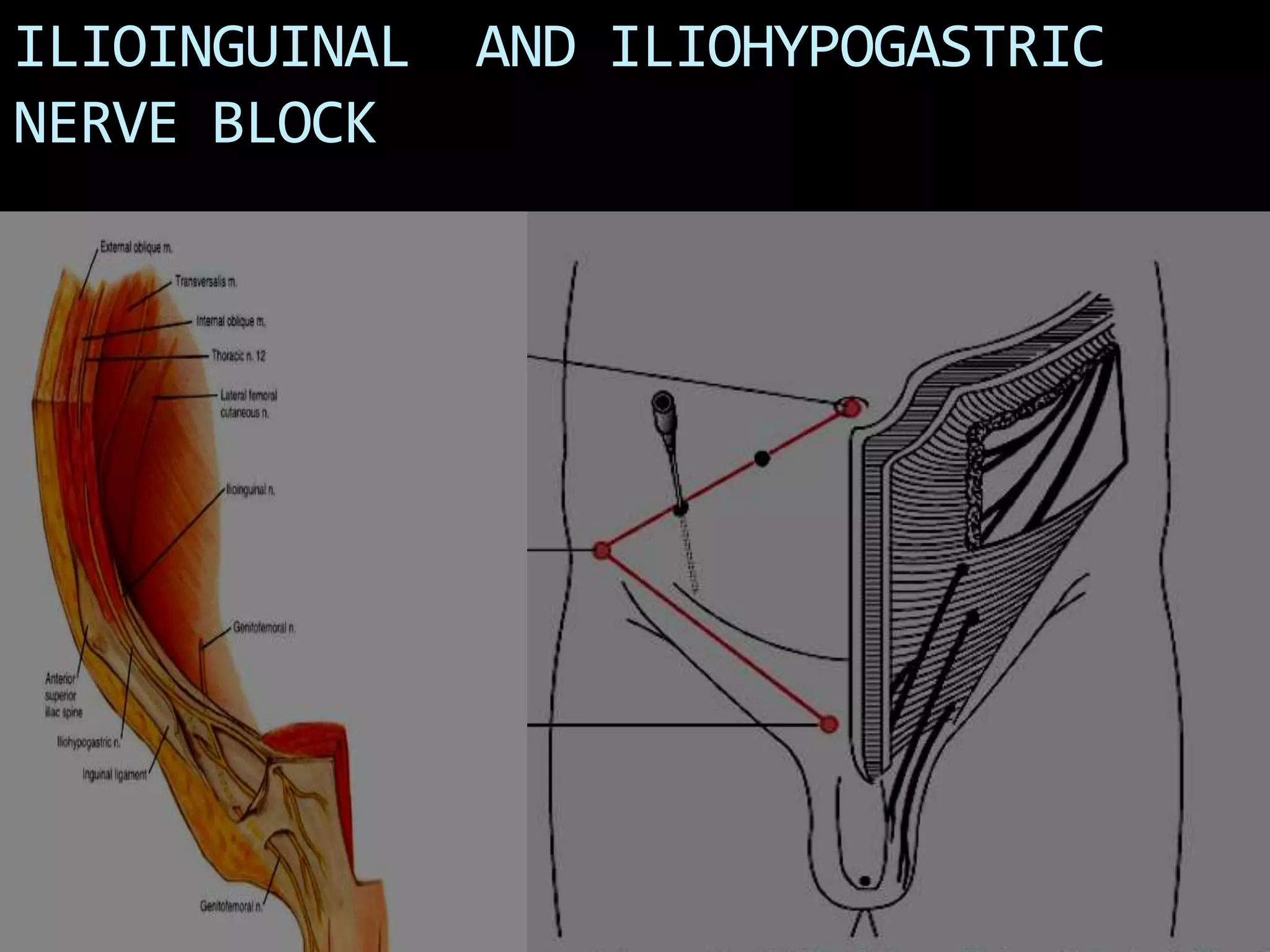 anesthesia for obstructed inguinal hernia | PPTX