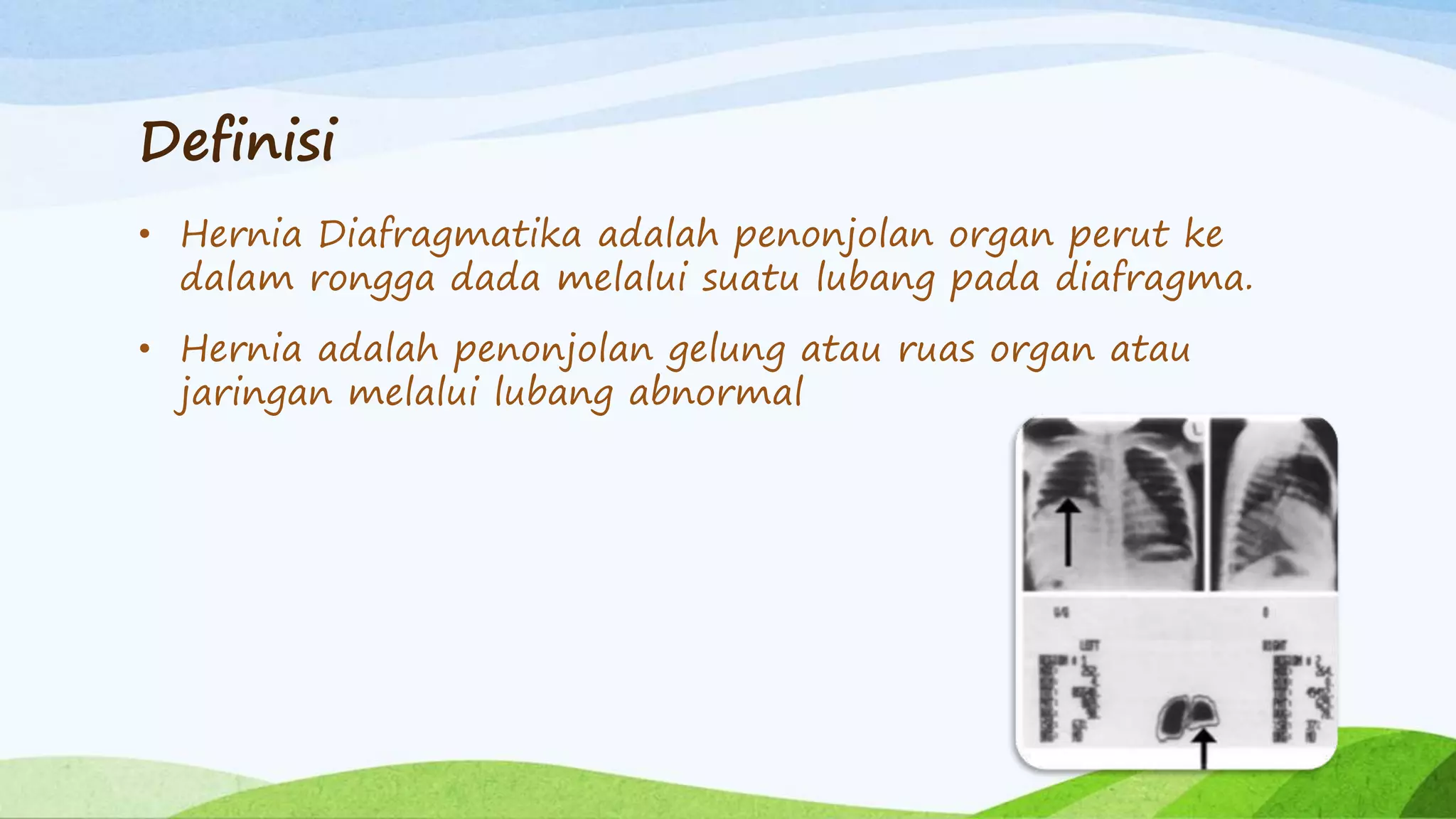 PPT Hernia Diafragmatika | PPTX