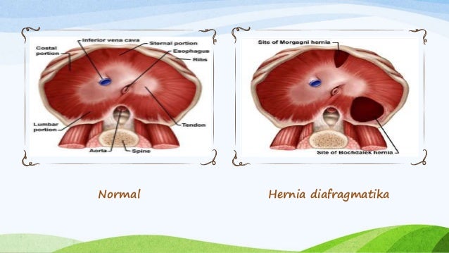 PPT Hernia Diafragmatika