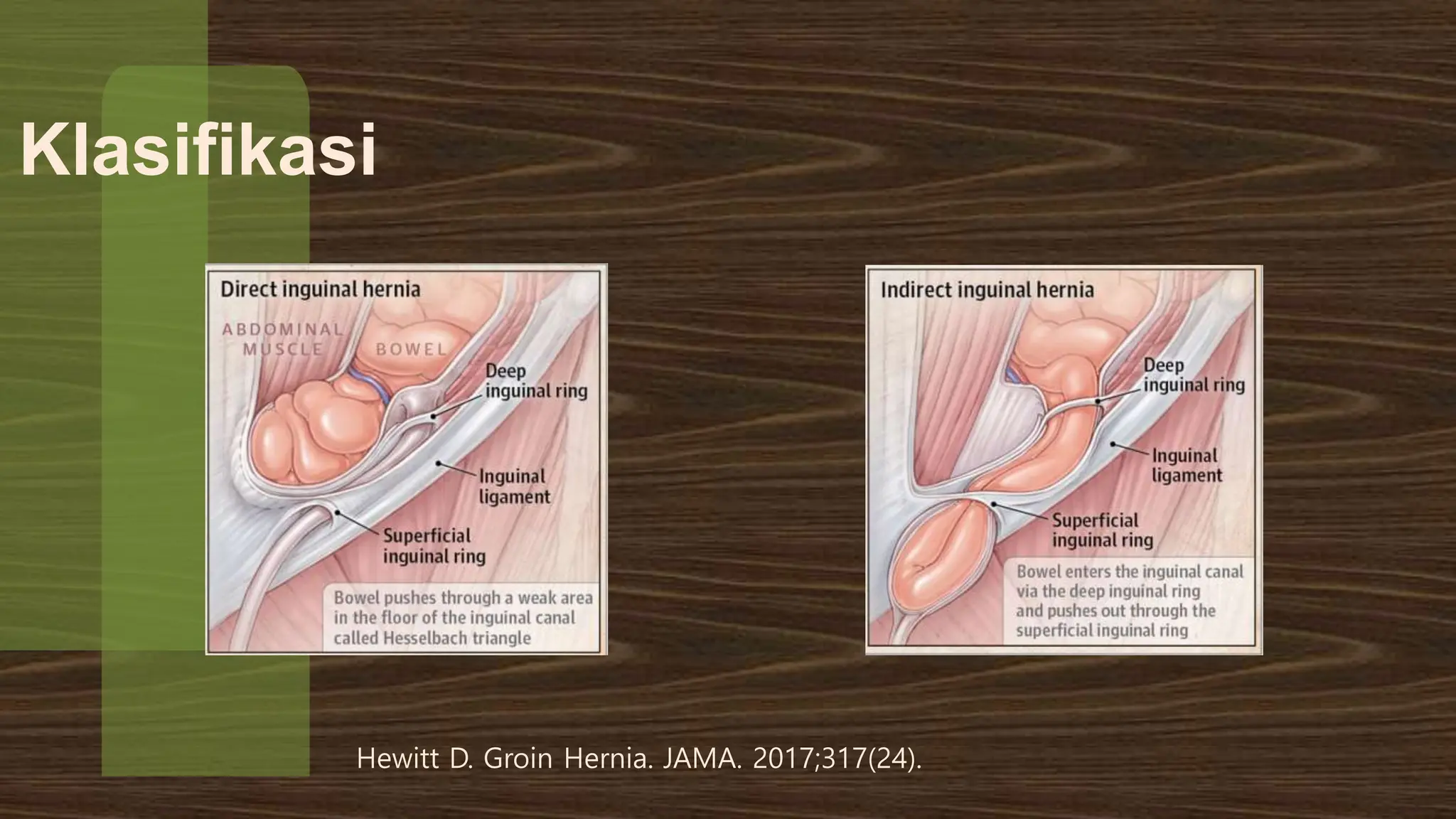 PPT Hernia inguinal-Ulfa Hayatun usk.pptx
