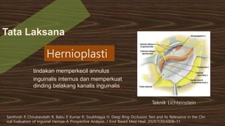 PPT Hernia inguinal-Ulfa Hayatun usk.pptx