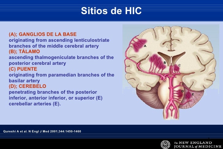 Hemorragia Intracerebral UPDATE Manejo Médico