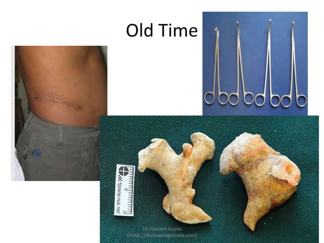 Kidney Stones for Patients - Diet and Medicines | PPT