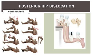 Ppt hip dislocation | PPT