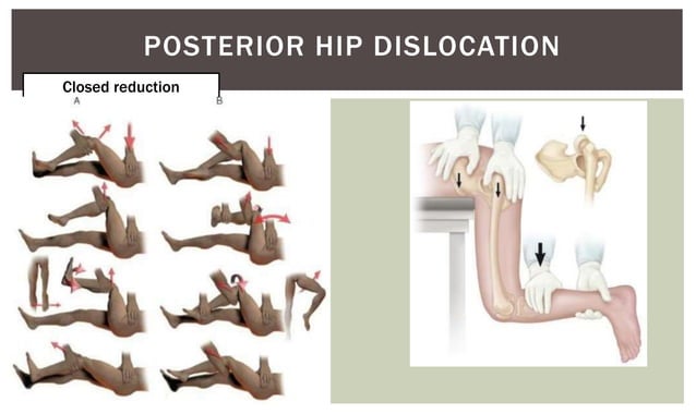 Ppt Hip Dislocation Ppt 0799