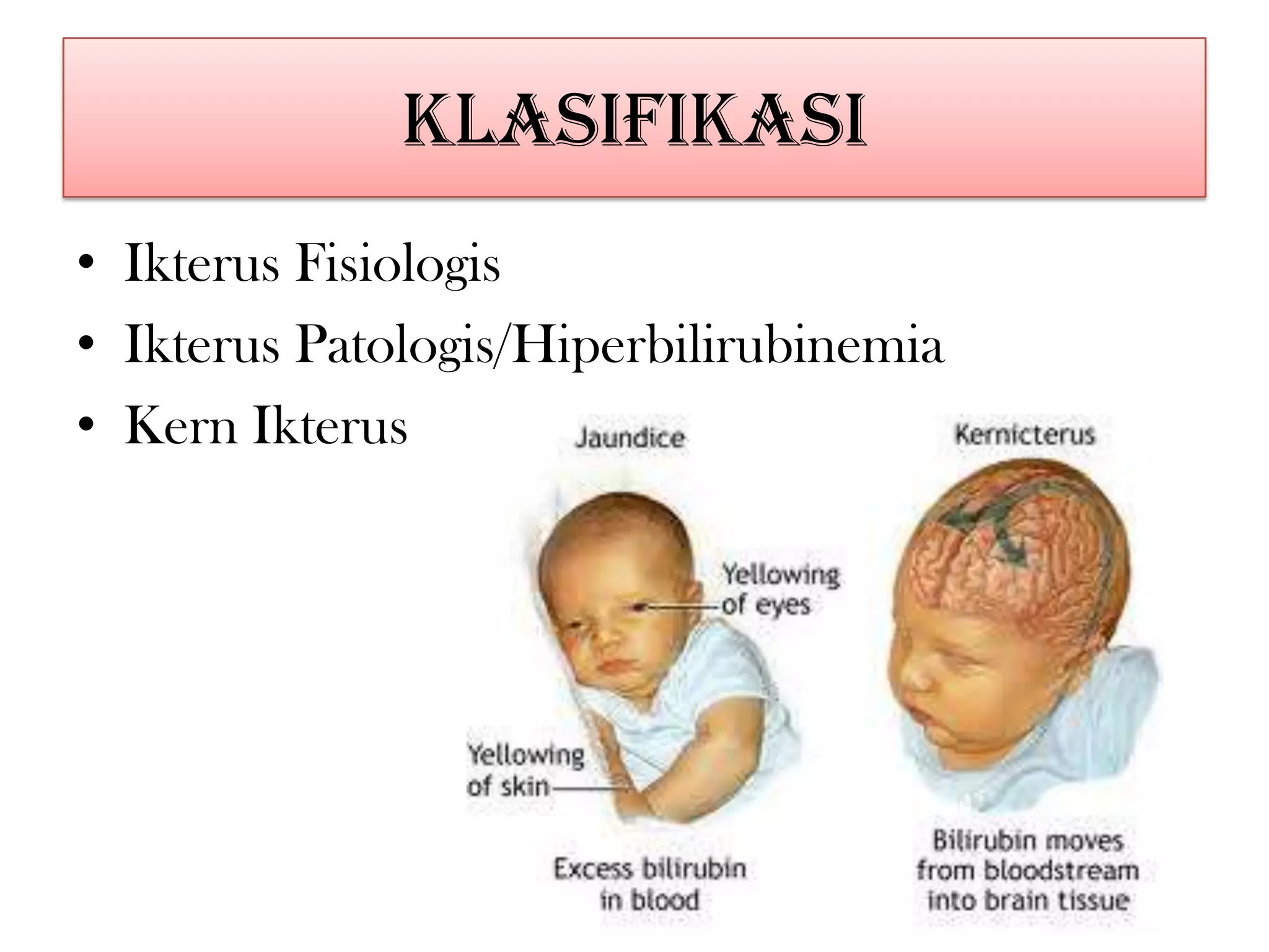 Ppt hiperbilirubin | PPTX