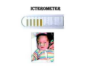 Ppt hiperbilirubin | PPTX